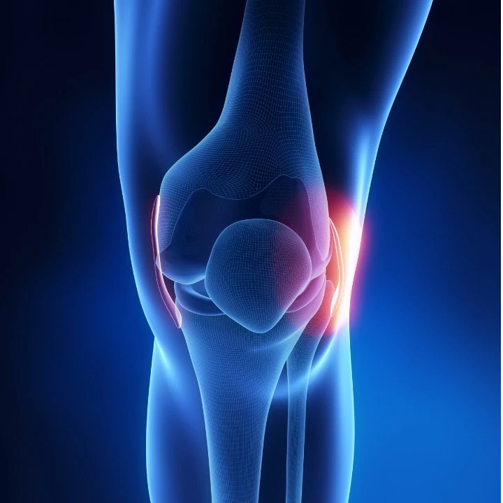 Racimo del LCM | Diagnóstico de las lesiones del ligamento colateral medial