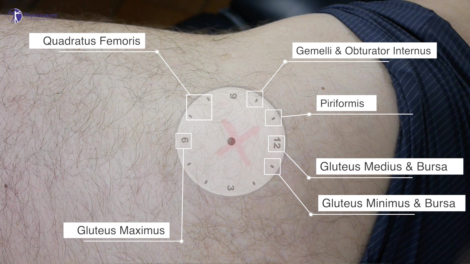 Palpation du grand trochanter | Tendinopathie fessière (GTPS)