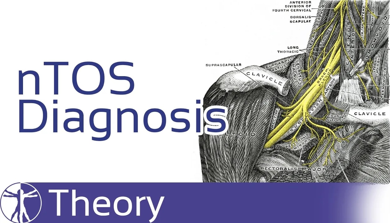 Diagnosis Sindrom Outlet Toraks Neurologis | nTOS
