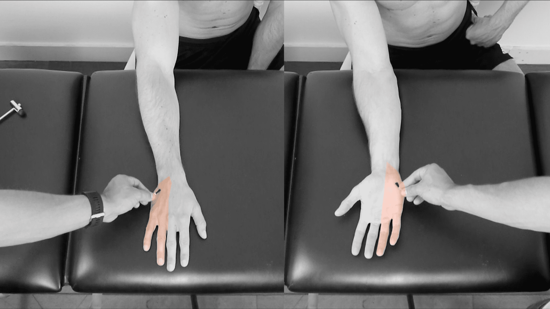 Dermatoom bovenste ledematen Perifeer neurologisch onderzoek