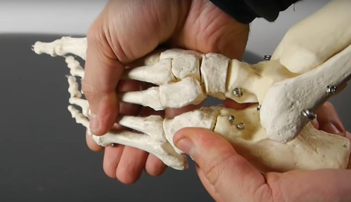 Cuboid Syndroom na laterale enkelverstuiking | Diagnose & Behandeling