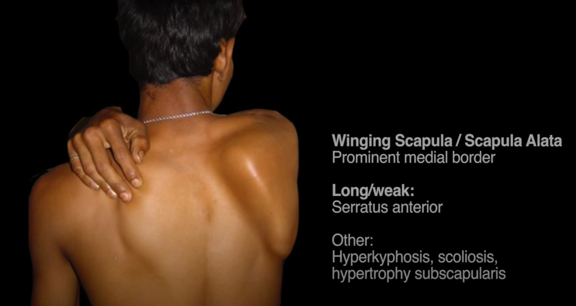 Scapular justering | Scapular dyskinesis vurdering