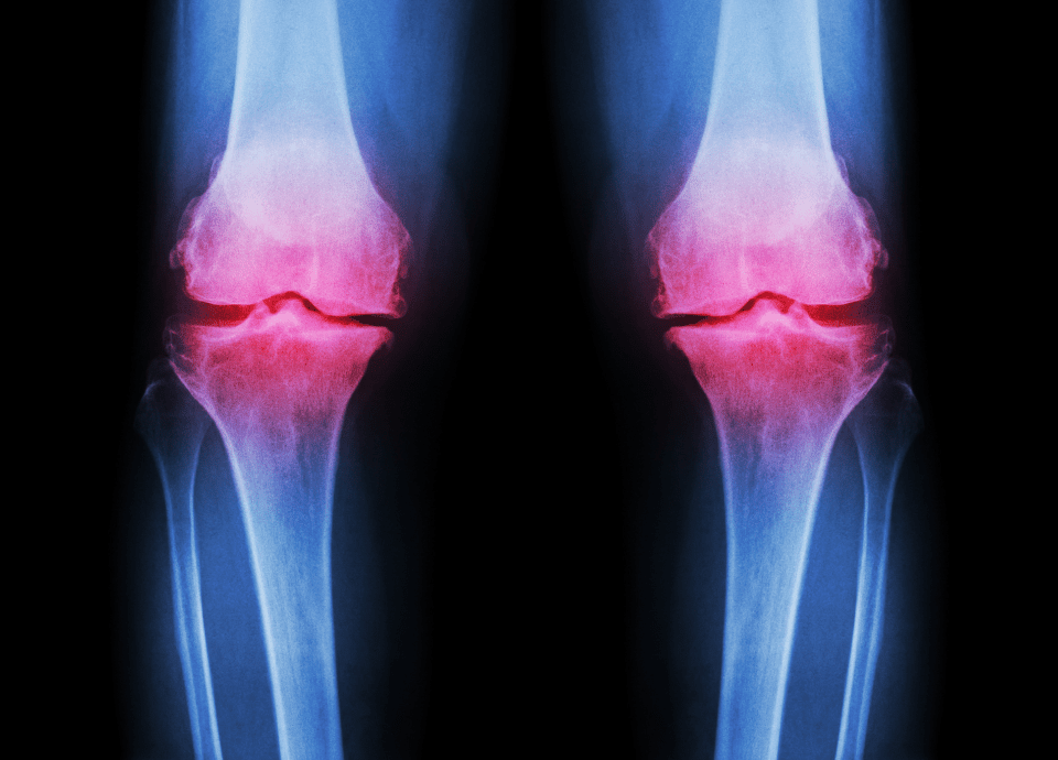 Episódio 014: OA do joelho com Anthony Teoli - Physiotutors