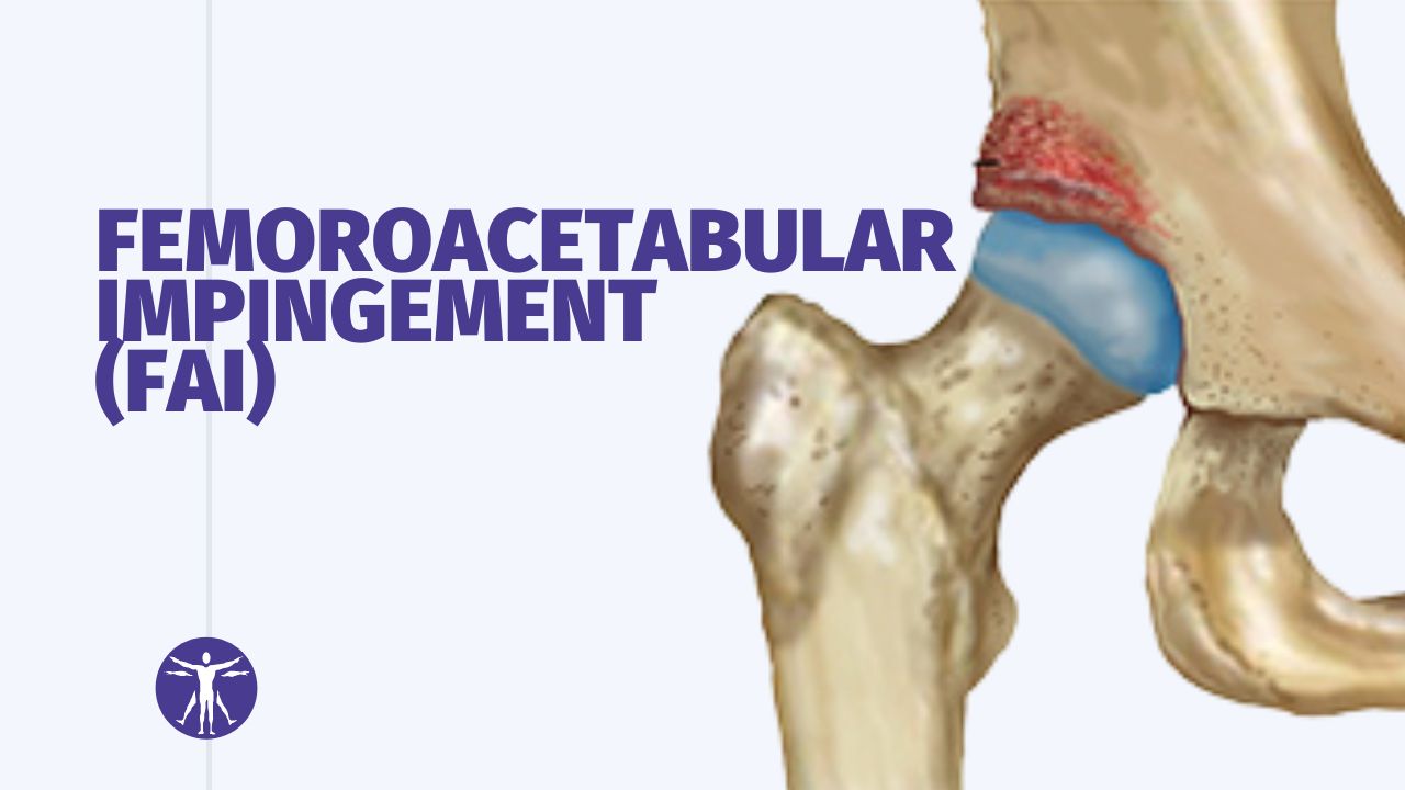 Impacto Femoroacetabular (FAI) | Diagnóstico e Tratamento