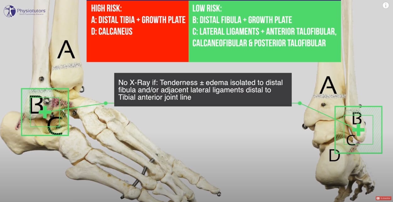 Low Risk Ankle Rule | Ankle Fractures in Children - Physiotutors