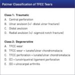 Fovea Sign | Triangular Fibrocartilage Complex (TFCC) Exam