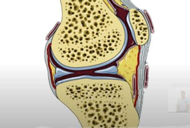Infrapatellar Fat Pad Syndrome | Diagnosis & Treatment